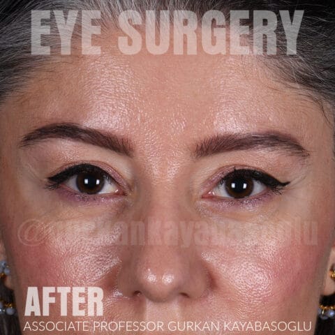 Eye Surgery - Prof. Dr. Gürkan Kayabaşoğlu - Maxillofacial Surgery