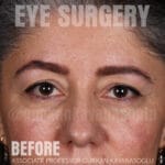 Eye Surgery - Prof. Dr. Gürkan Kayabaşoğlu - Maxillofacial Surgery